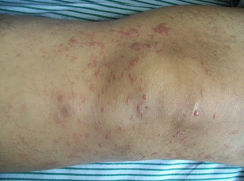 Cutaneous T cell Lymphoma Medlibes Online Medical Library